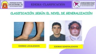 EDEMA_FISIOPATOLOGiATIPOS_Y_CARACTERSTICAS.pptx