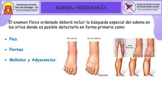 EDEMA_FISIOPATOLOGiATIPOS_Y_CARACTERSTICAS.pptx