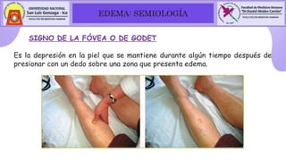 EDEMA_FISIOPATOLOGiATIPOS_Y_CARACTERSTICAS.pptx