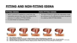 Edemahaemorrhage 160406002115 | PPTX
