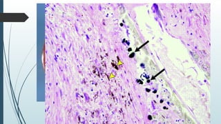 Edema, Hyperaemia, Congestion, Haemorrhage.pptx