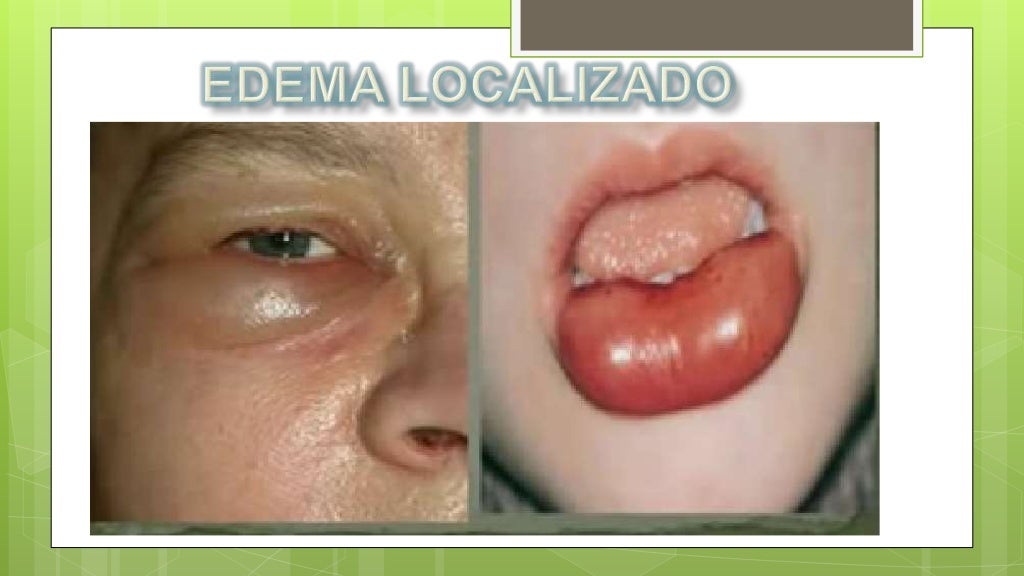 EDEMA