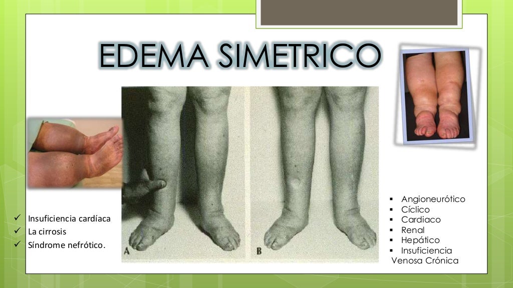 EDEMA