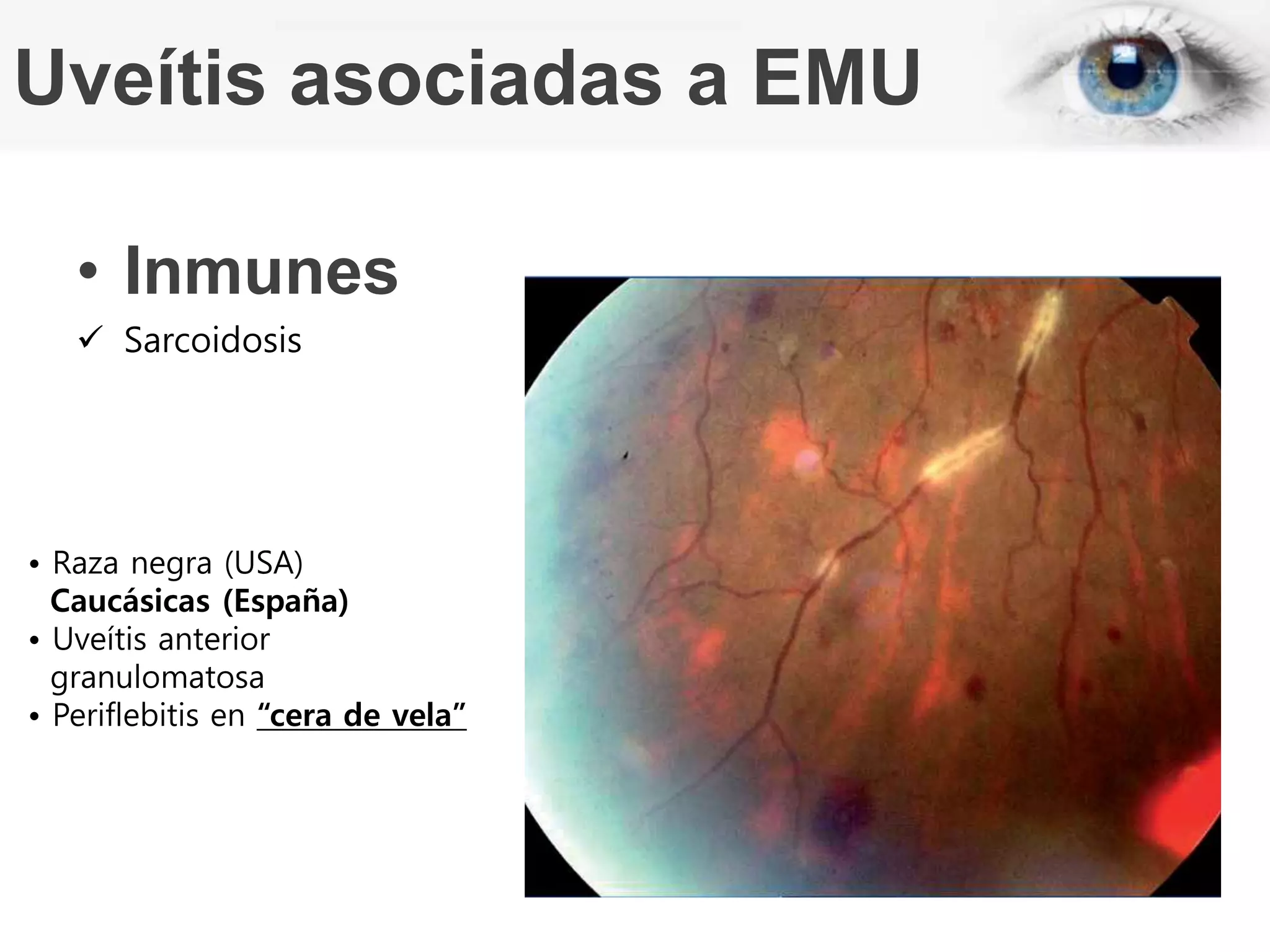 Edema macular uveítico def ronald sanchez | PPTX