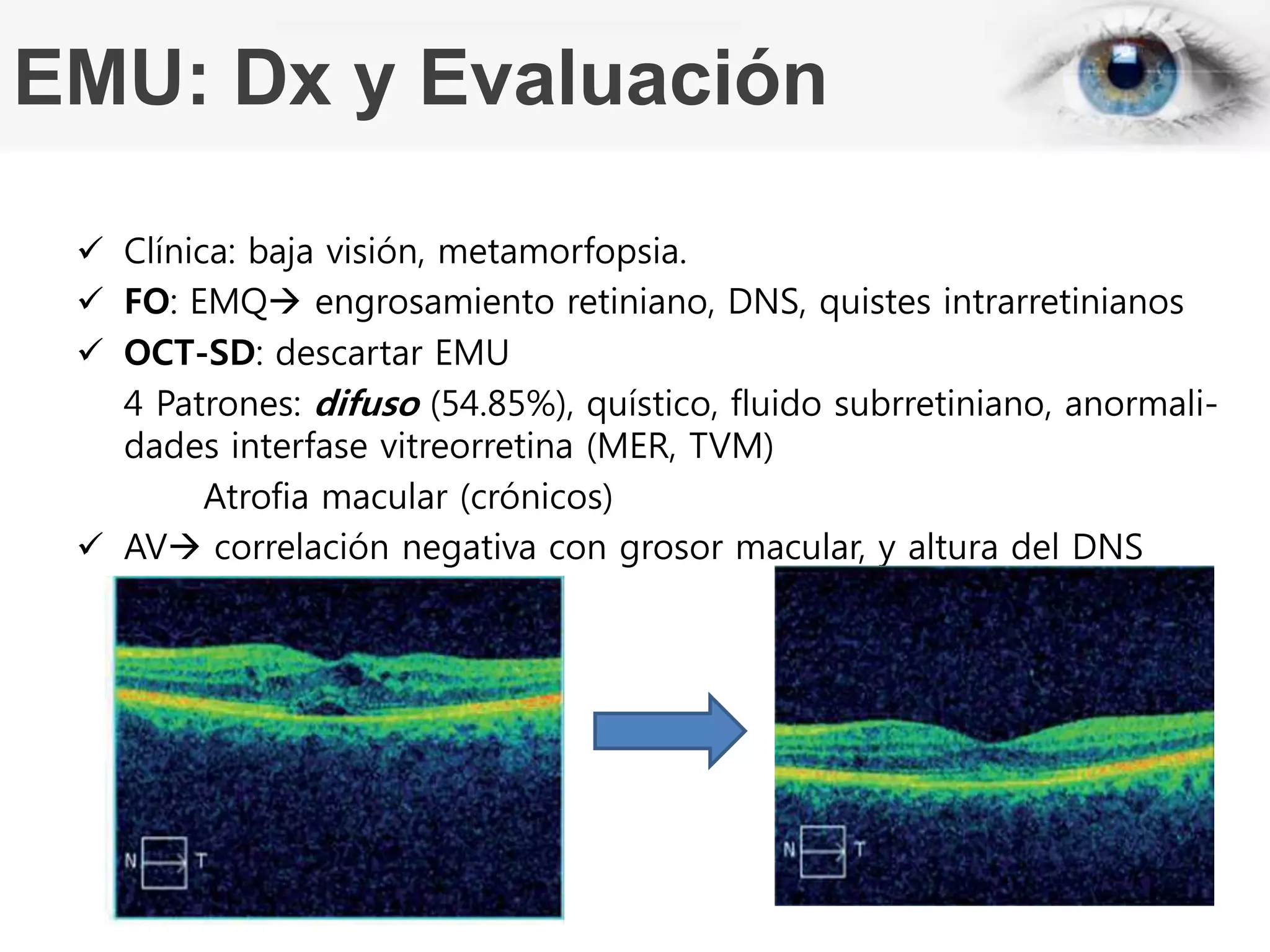 Edema macular uveítico def ronald sanchez | PPTX