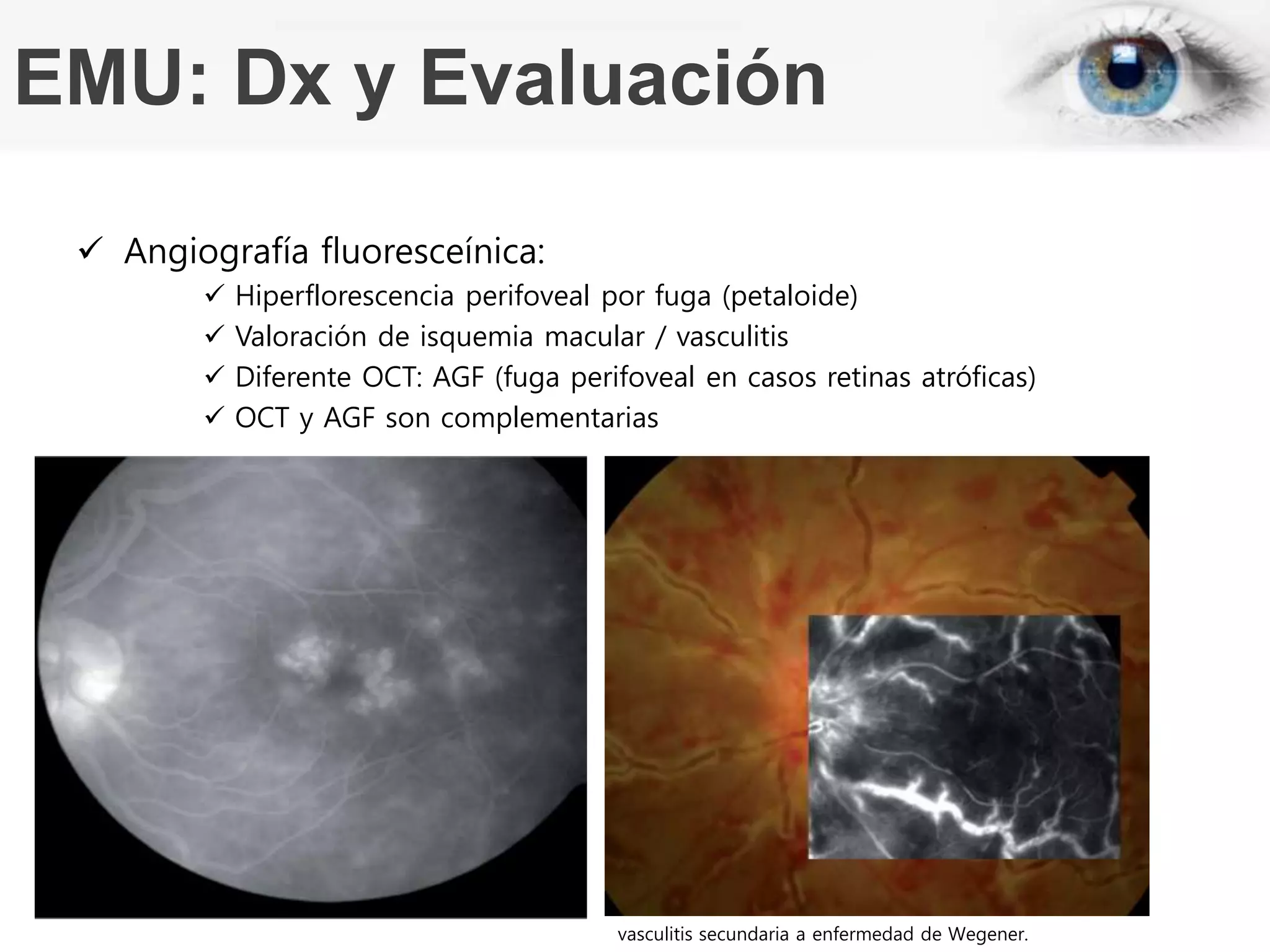 Edema macular uveítico def ronald sanchez | PPTX