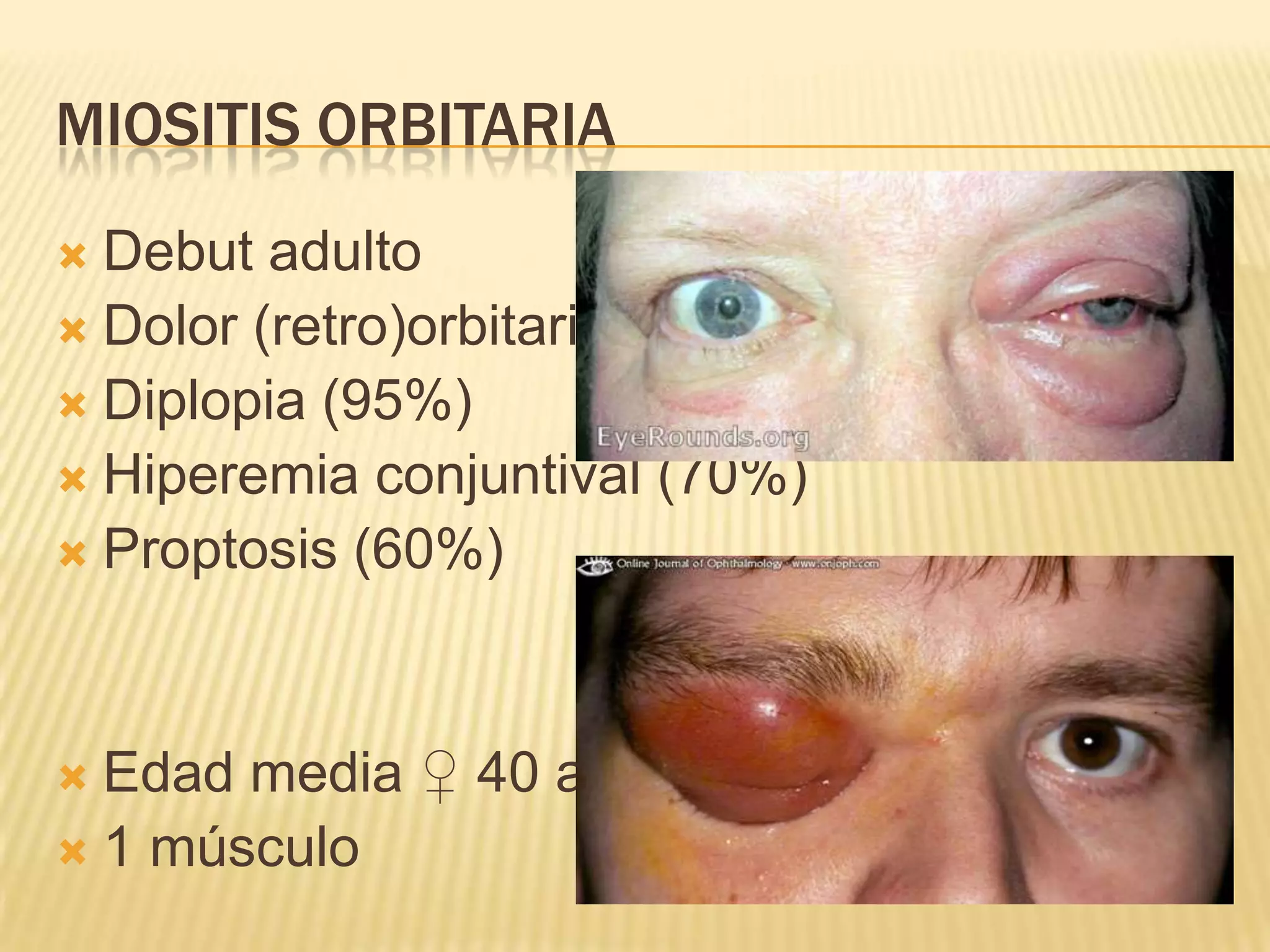 Diagnostico diferencial edema palpebral | PPTX