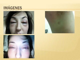 Diagnostico diferencial edema palpebral | PPTX