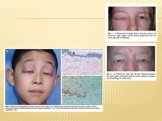 Diagnostico diferencial edema palpebral | PPTX