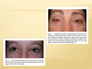 Diagnostico diferencial edema palpebral | PPTX