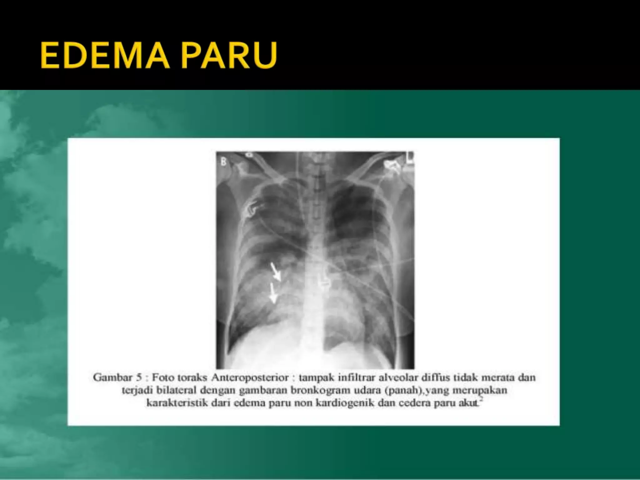 EDEMA PARU....pptx