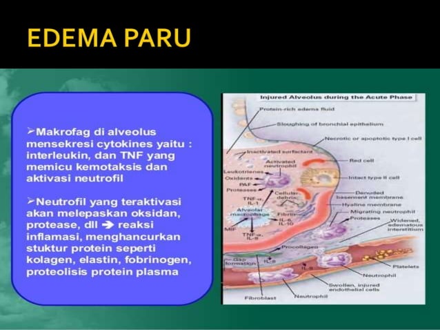 EDEMA PARU....pptx