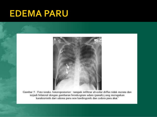 EDEMA PARU....pptx