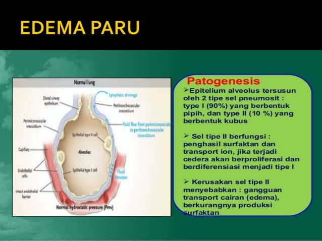 EDEMA PARU....pptx