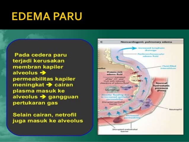 EDEMA PARU....pptx