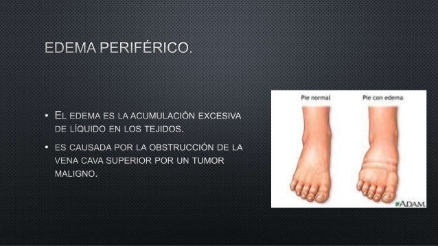 Edema periférico