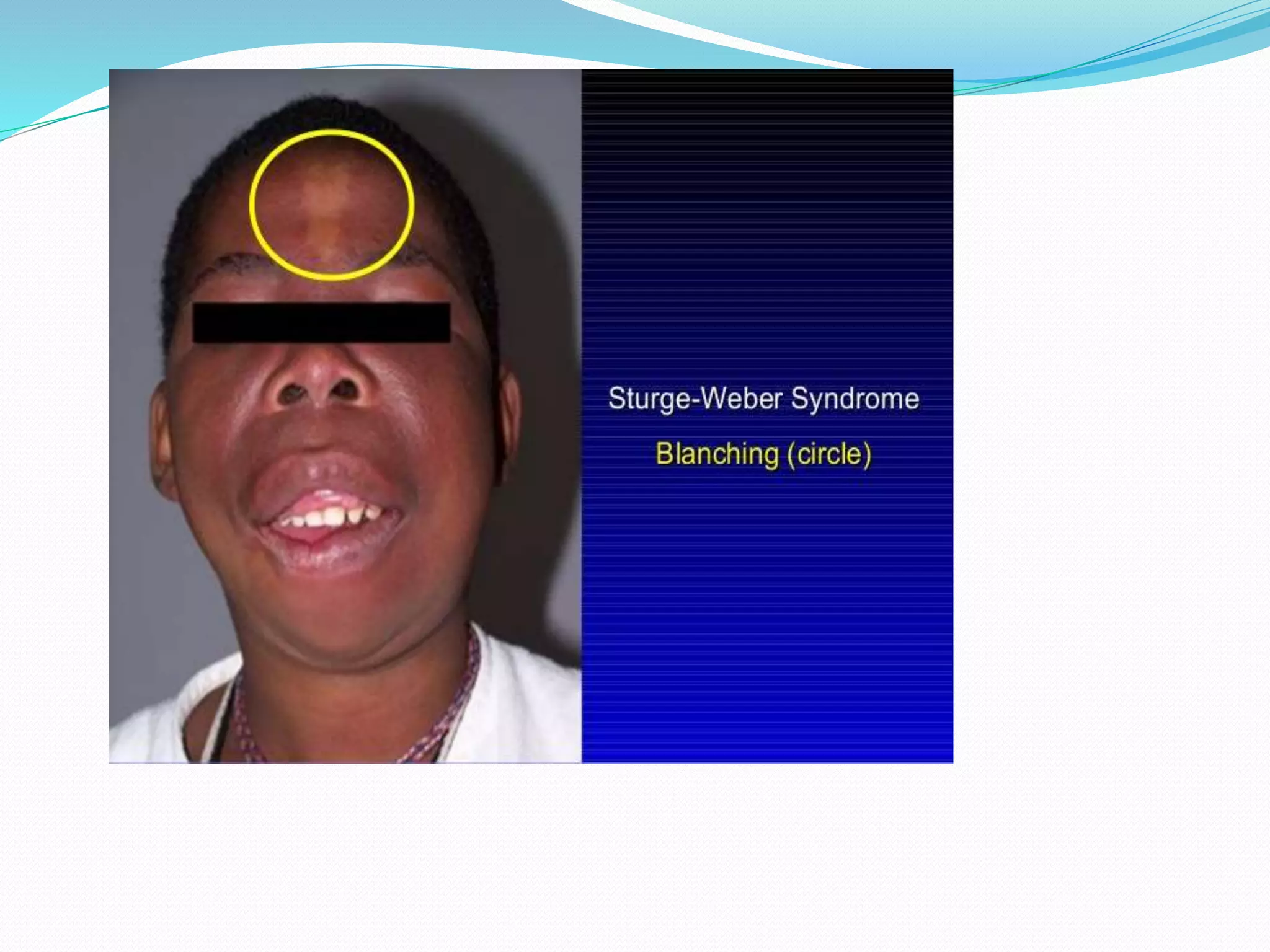 Hyperemia and congestion edema | PPTX