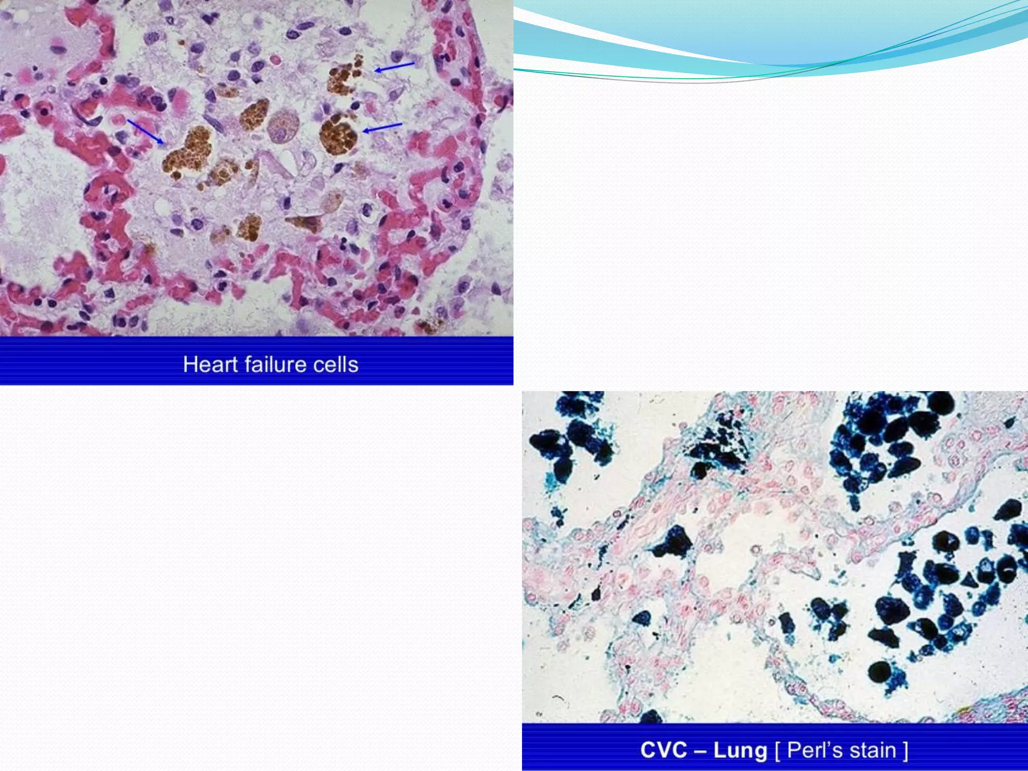 Hyperemia and congestion edema | PPTX