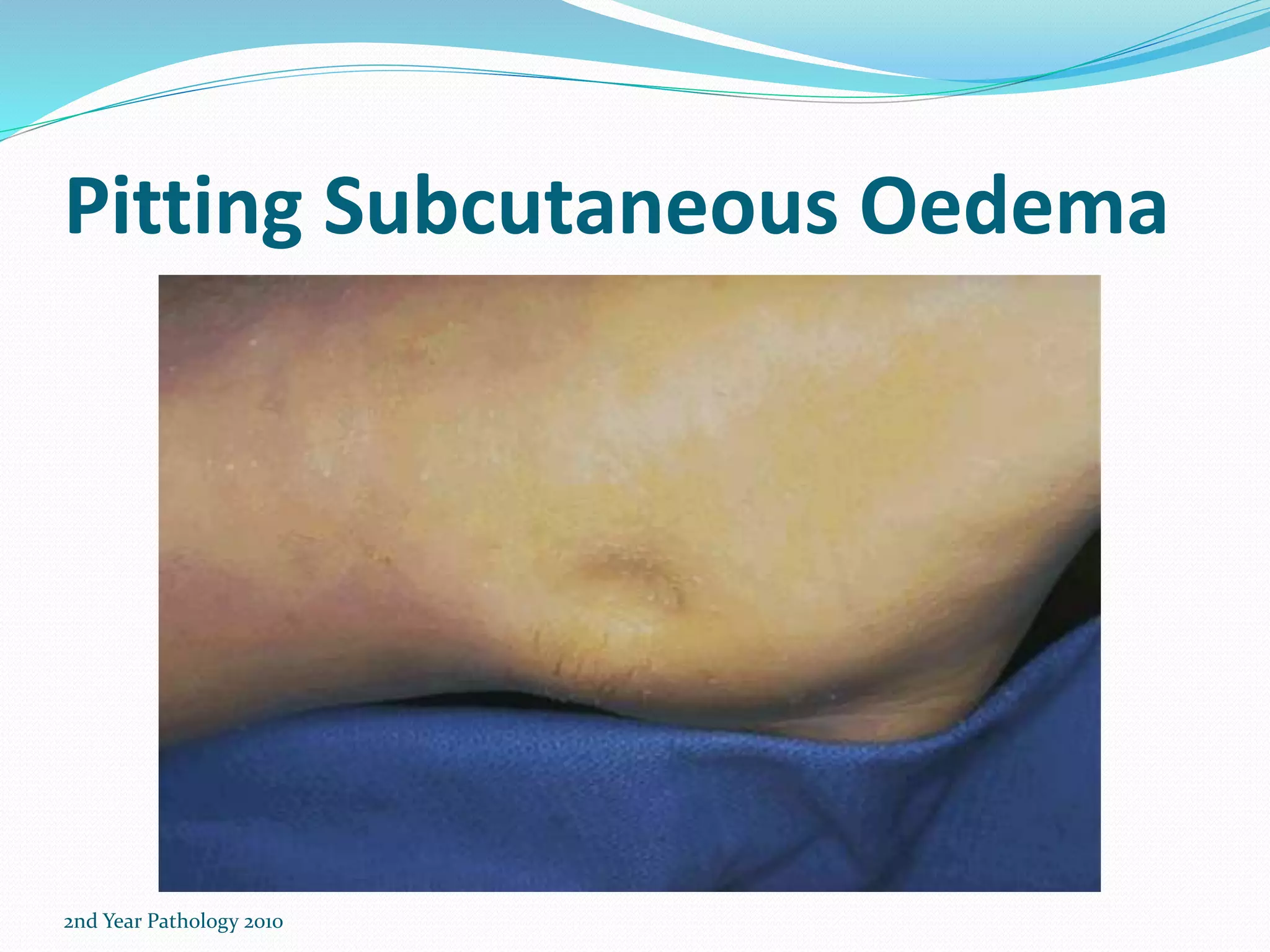 Hyperemia and congestion edema | PPTX