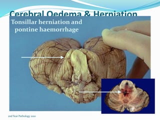 Hyperemia and congestion edema | PPTX