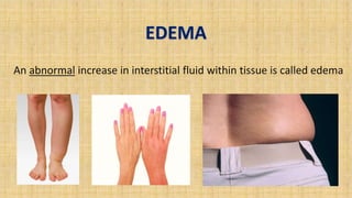 Edema | PPTX
