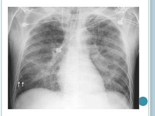 EDEMA PULMONAR I | PPTX