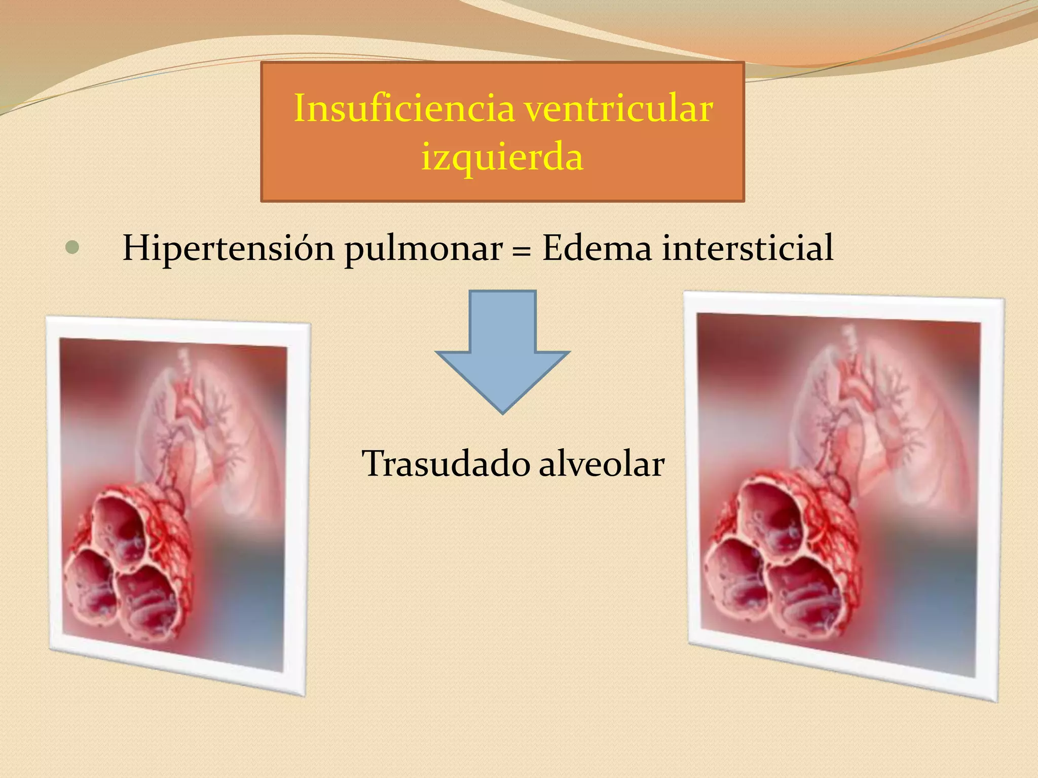 Edema pulmonar agudo cardiogeno | PPTX