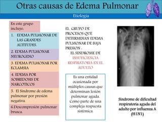 Signos Y Sintomas De Edema Pulmonar