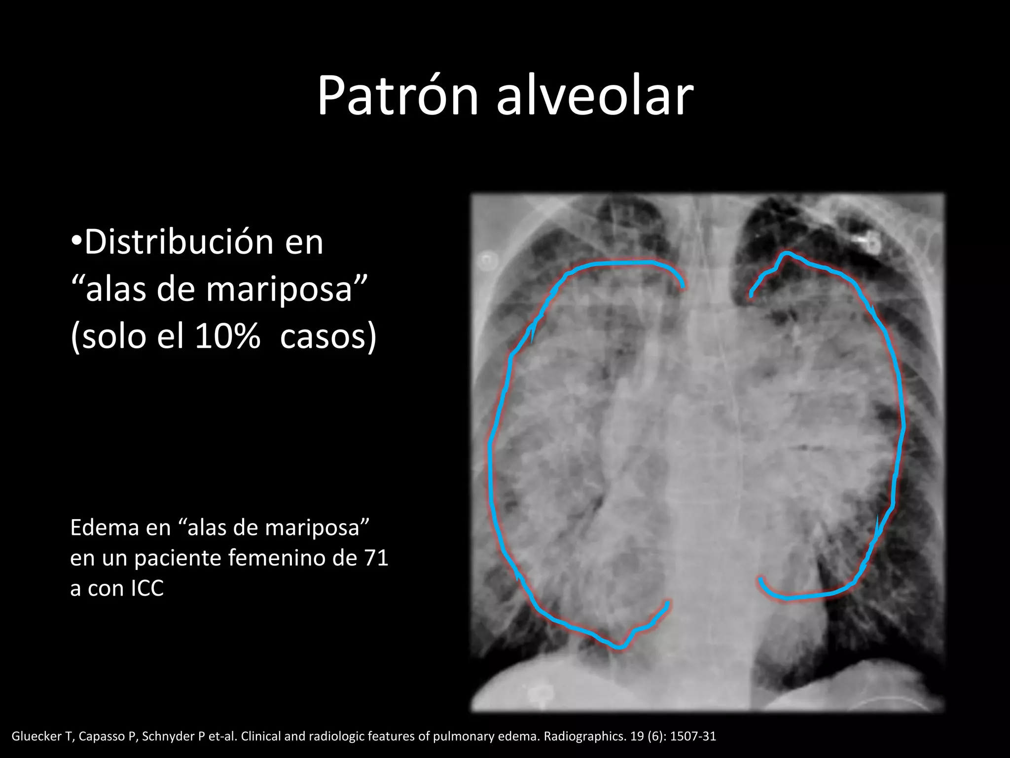 Imagenología de Edema agudo pulmonar | PPTX