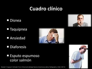 Imagenología de Edema agudo pulmonar | PPTX