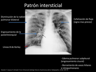 Imagenología de Edema agudo pulmonar | PPTX