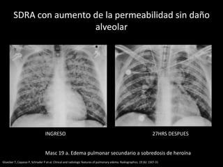 Radiografía De Edema Pulmonar