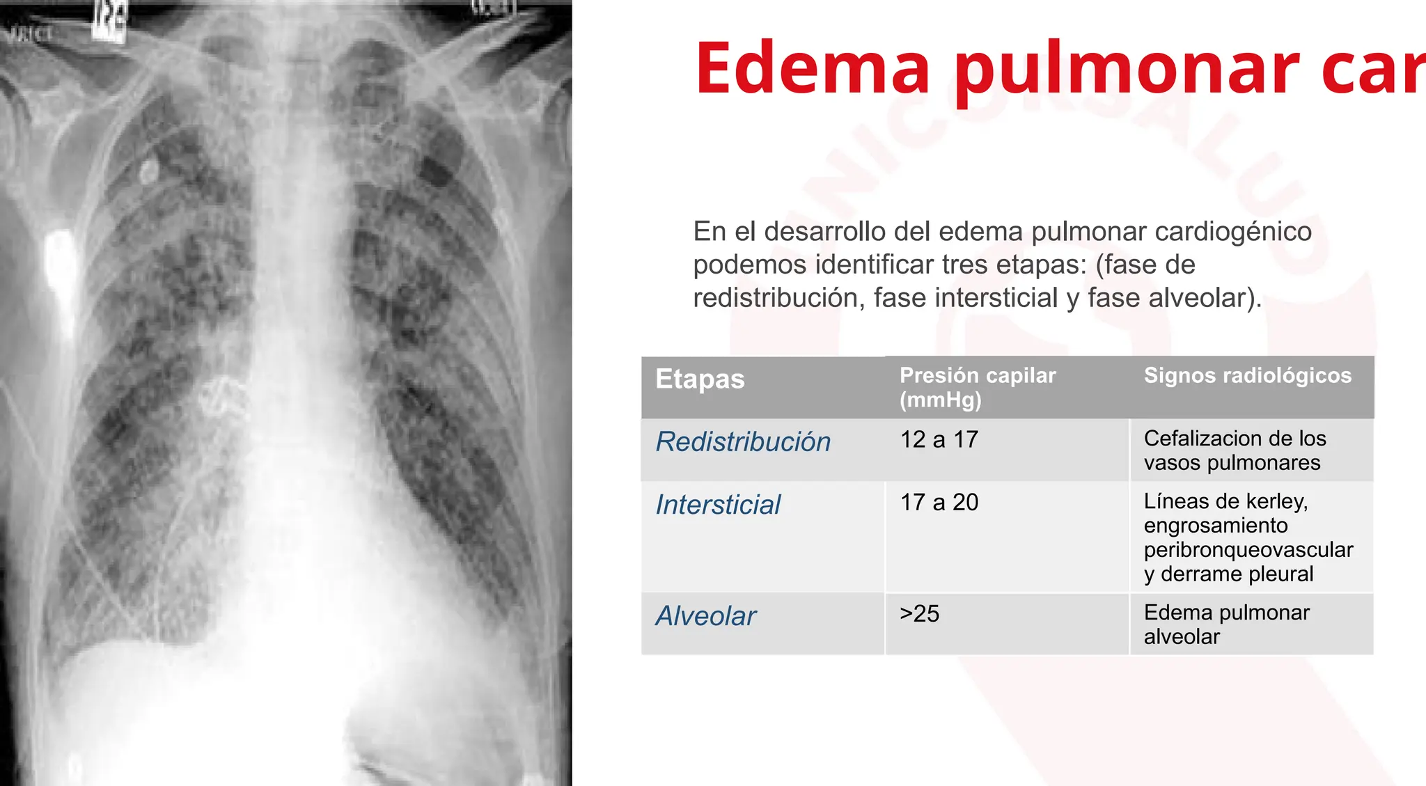Edema pulmonar: diagnostico por imágenes diagnósticas | PPTX