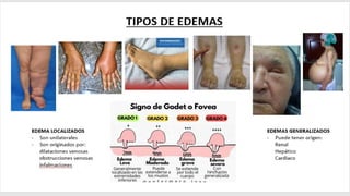 FISIOPATOLOGIA DEL EDEMA - PRINCIPIOS BASICOS | PPTX