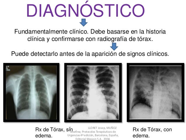 Edema Agudo de pulmon