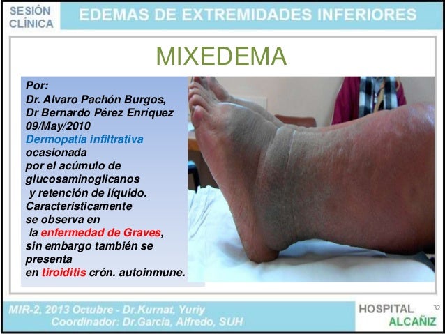 Edemas de extremidades inferiores