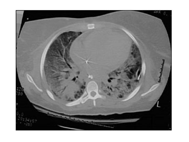 Edemul+pulmonar+acut