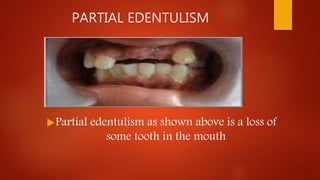 Edentulism | PPTX