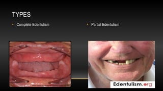 Edentulism | PPT