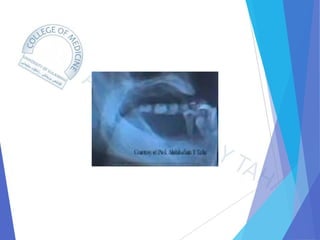 Edentulous Man Ingesting a Bone.pdf