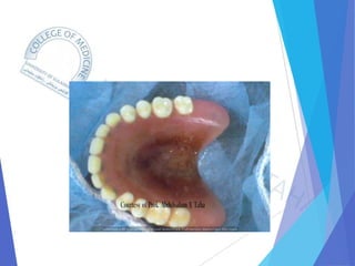 Edentulous Man Ingesting a Bone.pdf