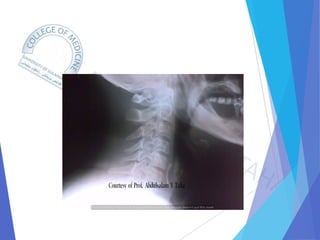 Edentulous Man Ingesting a Bone.pdf