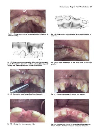 The Edentulous Ridge in Fixed Prosthodontics | PDF