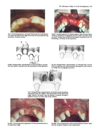 The Edentulous Ridge in Fixed Prosthodontics | PDF