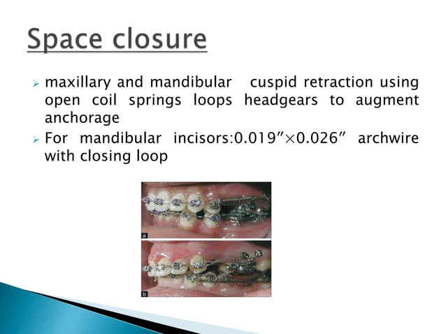 Edgewise appliance | PPT