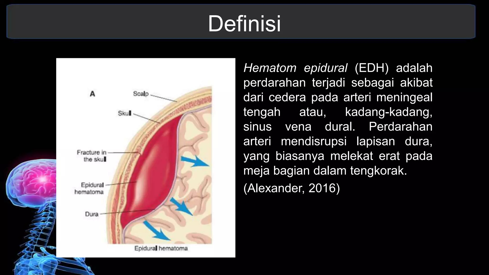 Epidural Hematoma | PDF