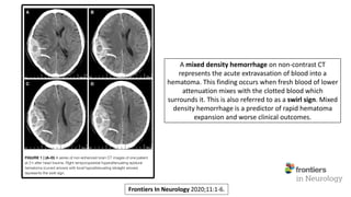 Neuroimaging Mastery Project Presentation #4: Acute Epidural Hematomas | PPT