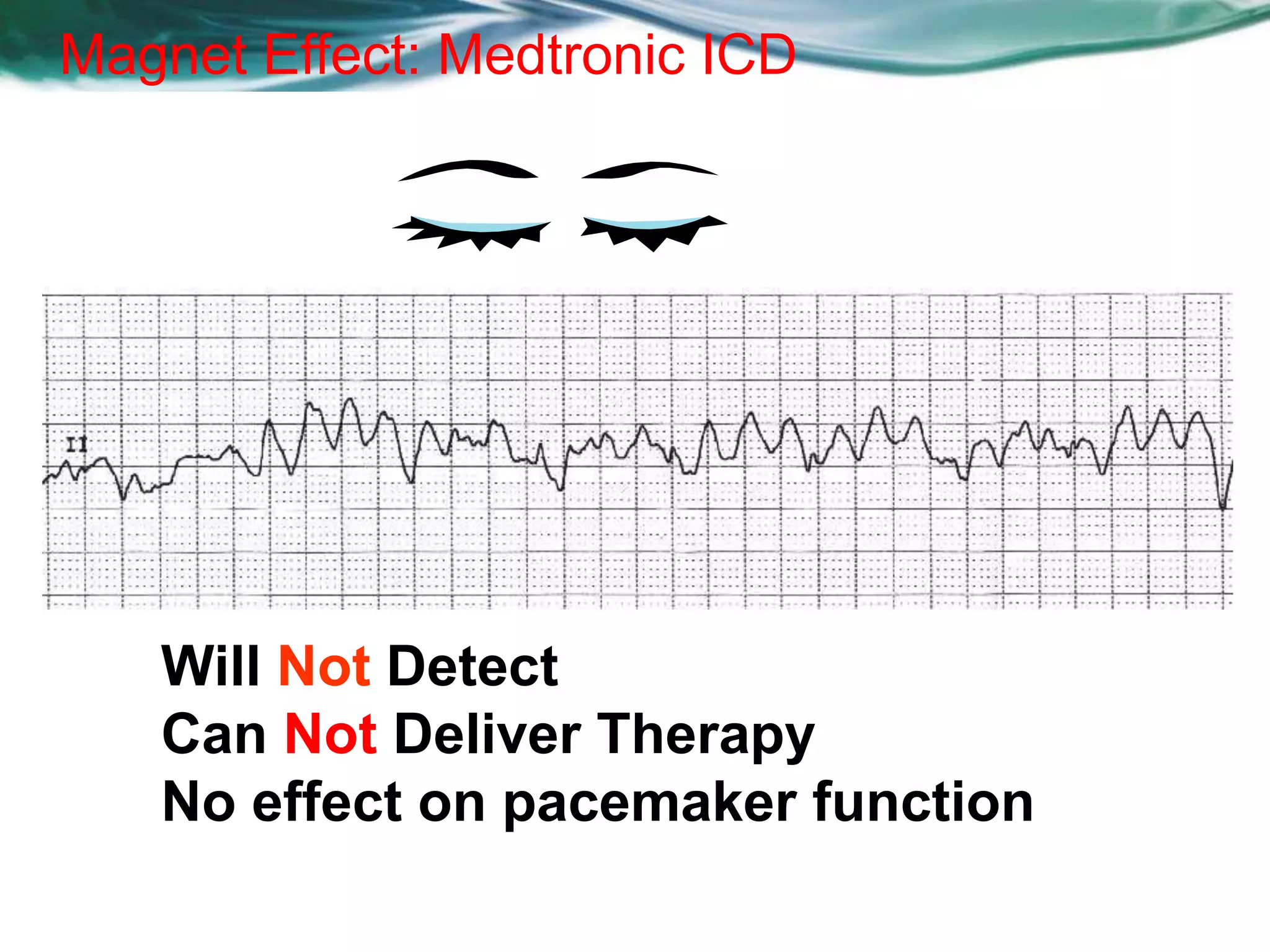 Emergency Department ICD and pacemaker issues | PPTX