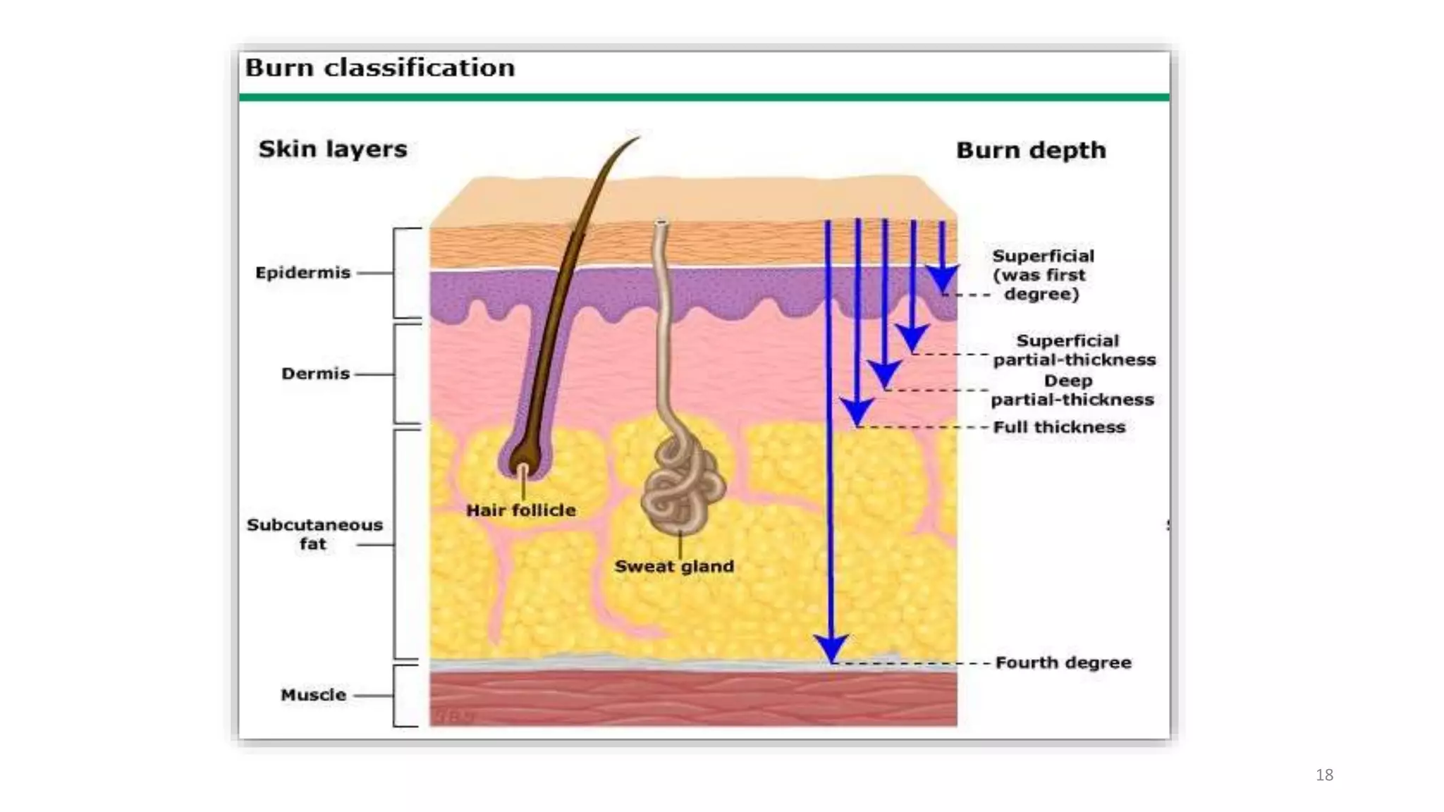 Classification, Principles, assessment and management of burn | PPTX