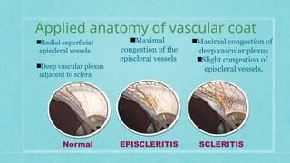 scleritis and episcleritis powerpoint for reading | PPTX